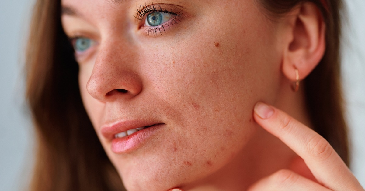 Adult Acne: Why It Happens and How to Treat It